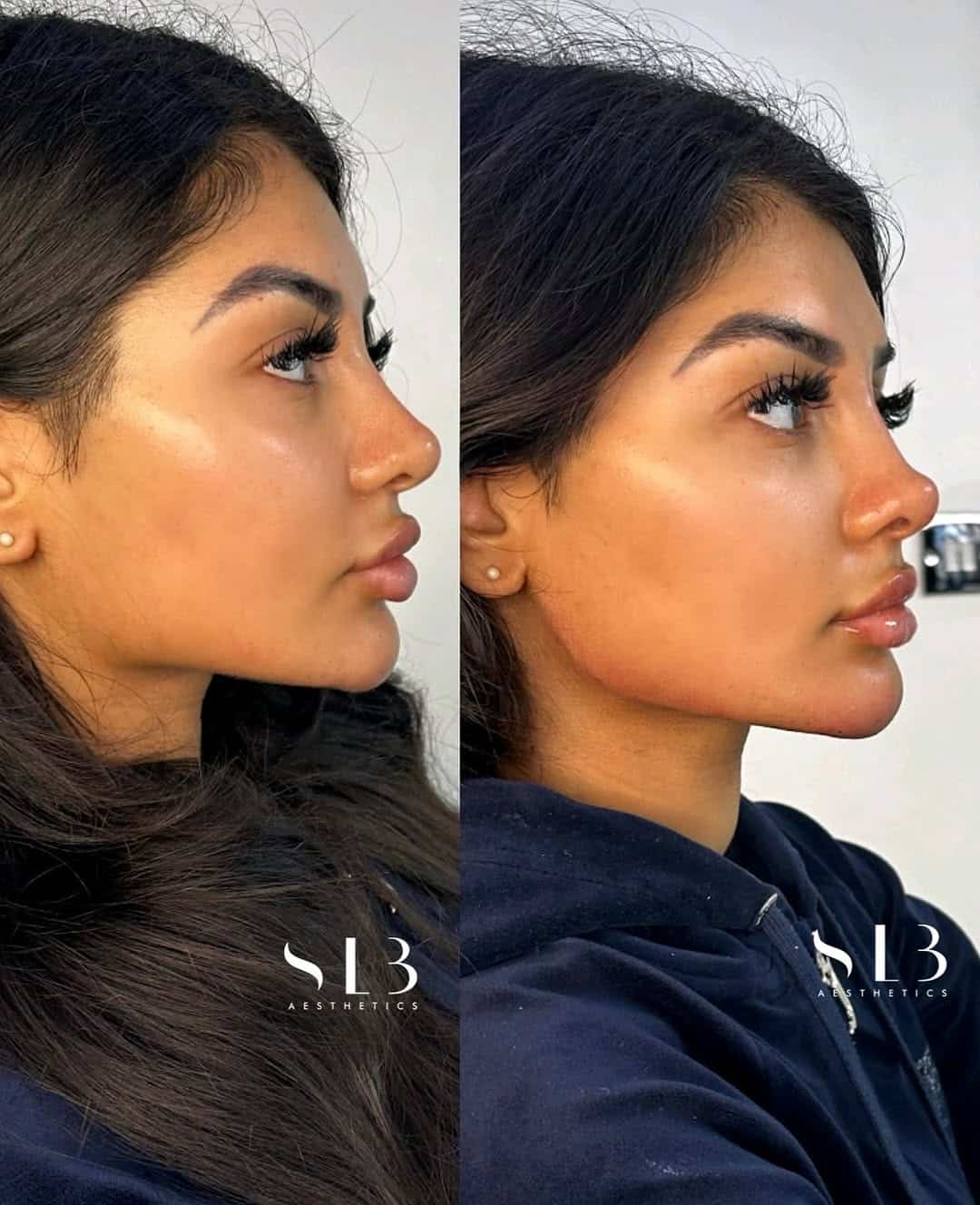 Jawline filler: Everything you need to know