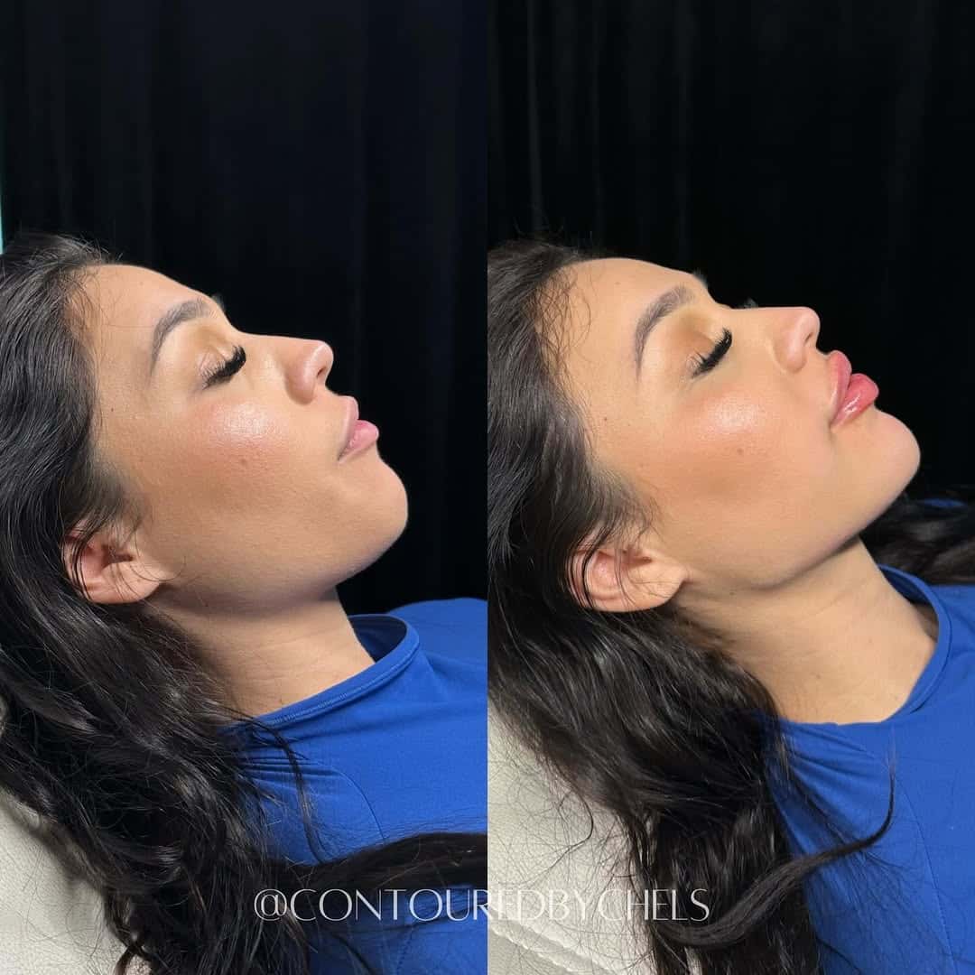 Jawline filler: Everything you need to know